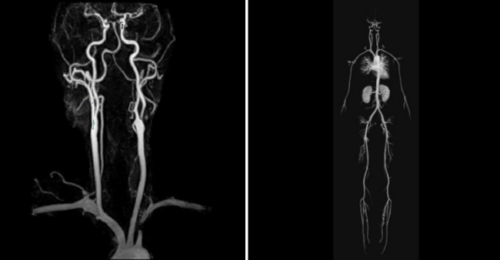 MRI Angiography – University Center Imaging